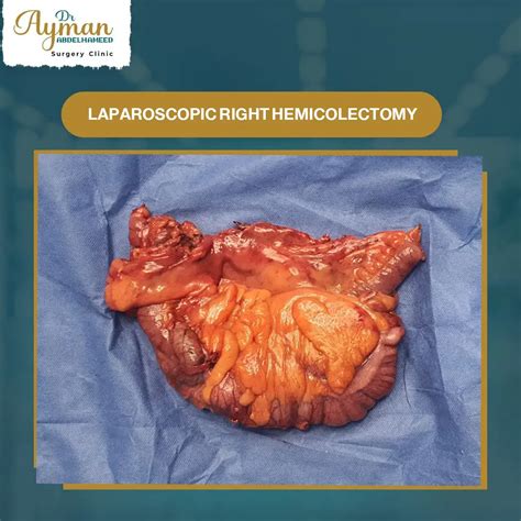 Laparoscopic Right Hemicolectomy Drayman Abd Elha