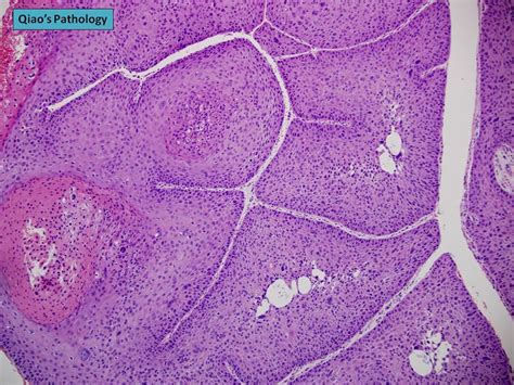Vulvar Intraepithelial Neoplasia