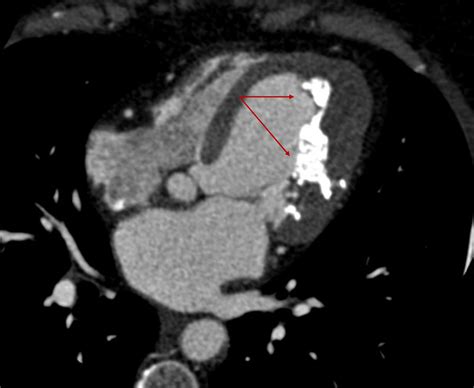 Incidental Discovery Of Dystrophic Myocardial Calcification Jacc Case Reports