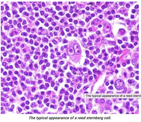 Lymphoma Flashcards Quizlet