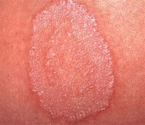 What Is Ringworm Nature Of Infection Explained Seacoast Laundry