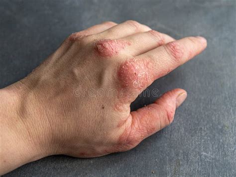 Psoriasis Skin Closeup Of Rash And Scaling On The Patient X S Skin Stock Image Image Of