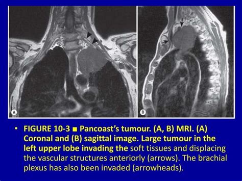 The Chest Wall Pleura Diaphragm And Intervention 10 Dr Muhammad Bin