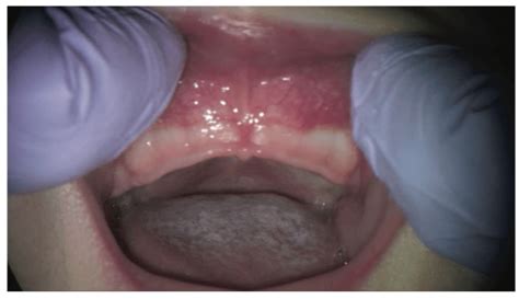 Frenillo Labial Tipo 1 Segun Kotlow • Mi Hijo No Habla