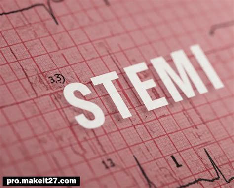 Stemi 의학용어 Os 의학용어 Ptbd 의학용어 Pro27