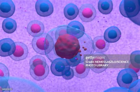 Multiple Myeloma Illustration High Res Vector Graphic Getty Images