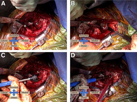 Intraoperative Pictures Of Glenoid Component Preparation In Right Download Scientific Diagram