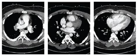 Advanced Diagnosis And Therapy For Chronic Thromboembolic Pulmonary