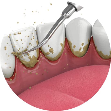 Non Surgical Periodontal Therapy Padhiar Periodontics