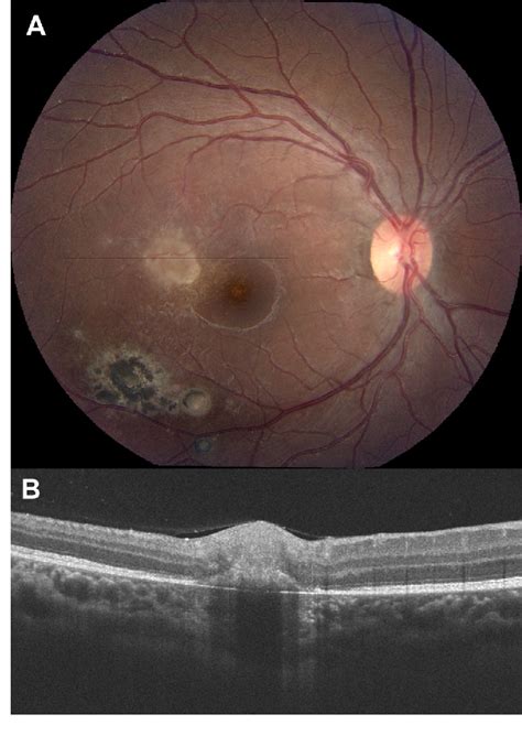 Chorioretinal Scar Semantic Scholar