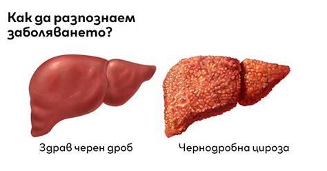 Цироза на черния дроб ≫ Какви са симптомите на цирозата Biotica Bg