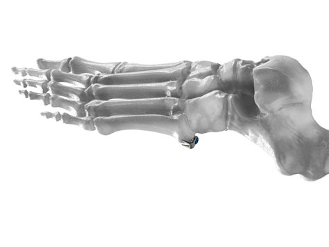 Jones Fracture — Centric Medical