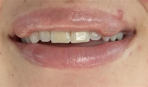 Lip Filler Bumps Rplasticsurgery