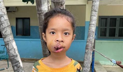 Success Ariya From Cambodia Raised 841 To Fund Surgery To Remove A