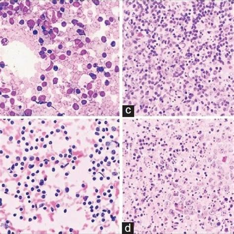 Fna Smear And Histology Of 4 × 3 Cm Right Cervical Lymph Node Of 2 Download Scientific Diagram