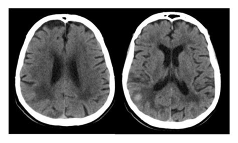Patient 1 Noncontrast Brain Ct Scan Showing Occipital Bilateral