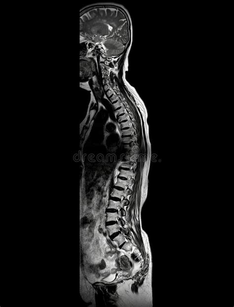 Mri Whole Spine Screening For Diagnosis Spinal Cord Compression Stock