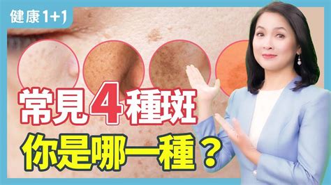 身上常見的4種斑老人斑黃褐斑色素沈澱等身體健康的警訊怎麼預防曝曬引發皮膚癌注意黑色素瘤 健康1 1 小影片 YouTube