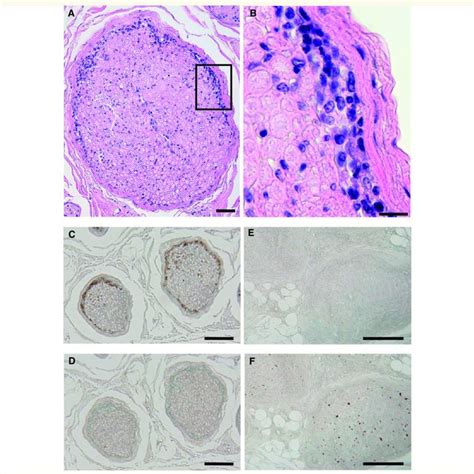 Nodular Sclerosing Pattern Of Hodgkins Lymphoma Download Scientific