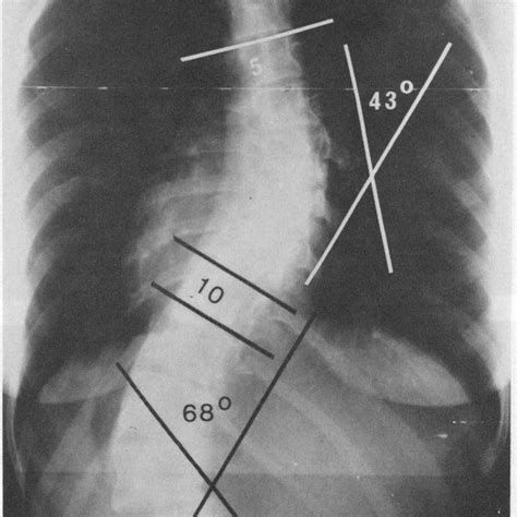 The Posteroanterior Pa Scoliosis View Shows A 37 Degree Right