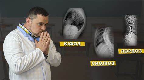 Сколіоз кіфоз лордоз — порушення постави які можна виправити