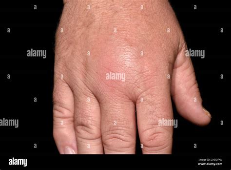 Gout Of The Metacarpophalangeal Mcp Joint Of A 54 Year Old Man Gout