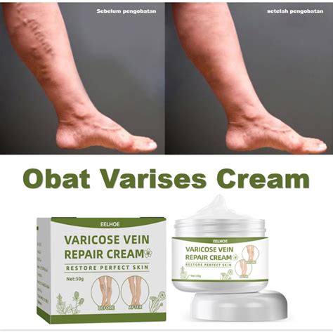 Jual Efektif Permanen Krim Varises Cream Varises Angiitis Salep