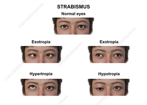 Woman With Various Strabismus Types Illustration Stock Image F042