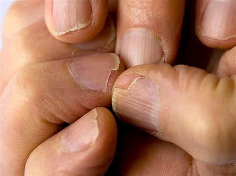 Nails Will Tell About The Health Of The Liver These 5 Symptoms Will Indicate The Disease Newscrab
