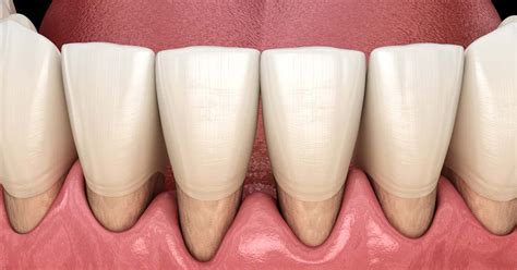 What Causes Gingival Recession