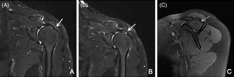 A Preoperative Mri Scan Of A 52‐year Old Man With Ellman Grade Ii
