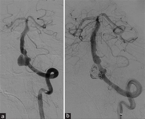 A Bilobed Fusiform Dilatation At The V4 Segment Of The Left Vertebral