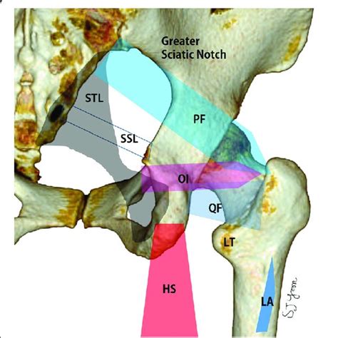 Pdf Clinical Results Of Endoscopic Sciatic Nerve Decompression For
