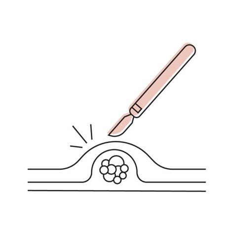 20 Incision Skin Illustrations Royalty Free Vector Graphics And Clip