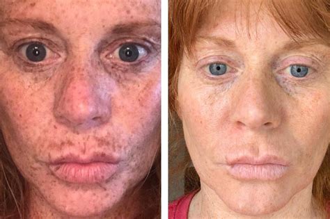 Hydroquinone Cream Before And After