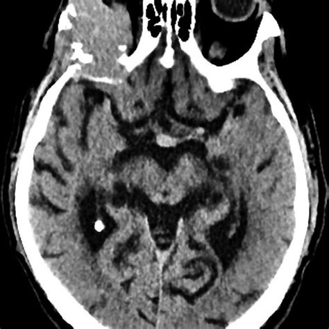 Coronal Fusion Images Of F Fdg Pet Ct Scan Showing F Fdg Uptake In