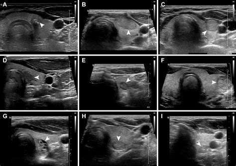 Transverse And Longitudinal Ultrasound Location Of Thyroid Nodules And