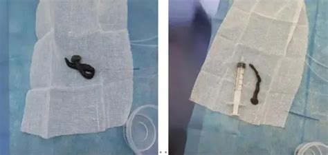 雲南女子狂咳半月痰中帶血絲 氣管拉出8cm水蛭 醫生：或飲用山泉水所致 Am730