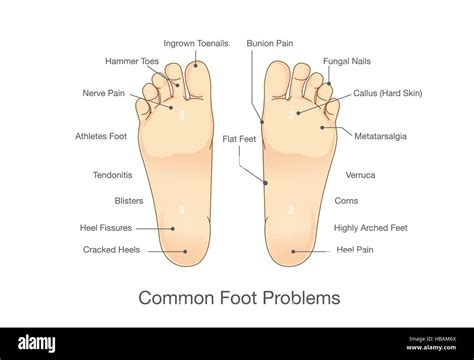 Common Foot Problems Stock Vector Image And Art Alamy