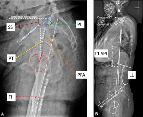 Illustration Of The Radiographic Parameters Of The Sagittal Alignment