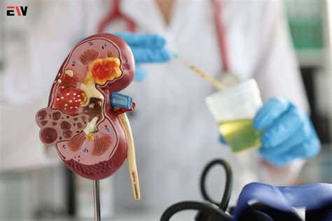 Iga Nephropathy Symptoms Causes And Treatment Enterprise Wired