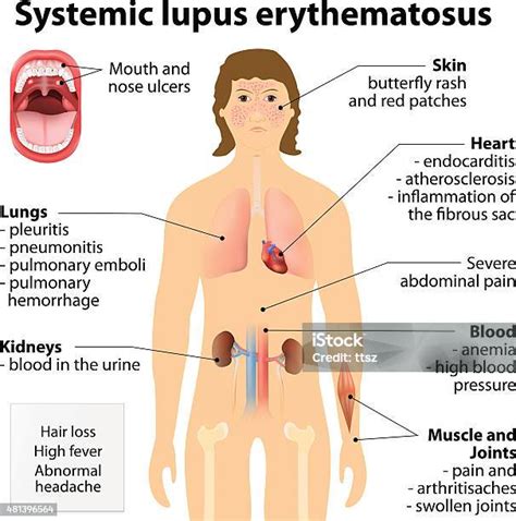 조직 Lupus Erythematosu 전신홍반루푸스에 대한 스톡 벡터 아트 및 기타 이미지 전신홍반루푸스 질병 증상