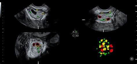 Monitoring Ovulation Ultrasound