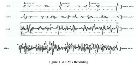 Interference Pattern Emg