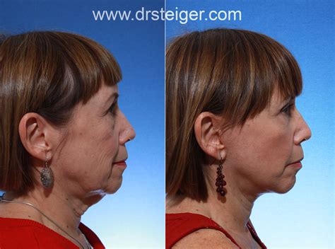 Facelift Surgery With Eyelid Surgery Steiger Facial Plastic Surgery