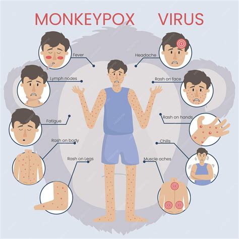 Concepto Infográfico Del Virus De La Viruela Del Mono 2022 El Hombre Está Enfermo De Viruela Y