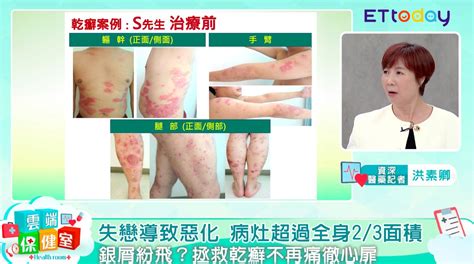 拯救乾癬早期積極治療是關鍵新式生物製劑助中重度患者脫離苦海 ETtoday健康雲 ETtoday新聞雲