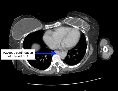 Missing Inferior Vena Cava On Pocus A Case Of Left Sided Ivc With