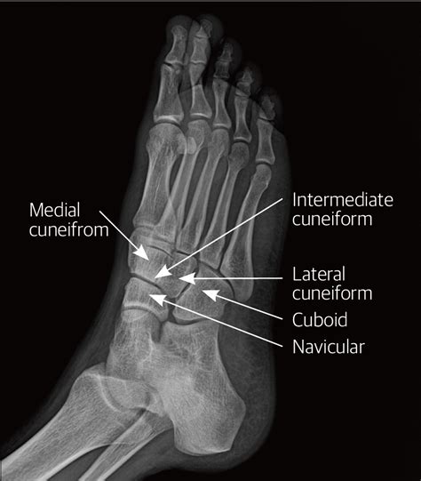 주상골 설상골 입방골 골절 Fracture Of Navicula Cuneiform Or Cuboid Metamedic