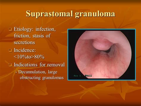 Pediatric Tracheotomy An Update Shraddha Mukerji Md University Of